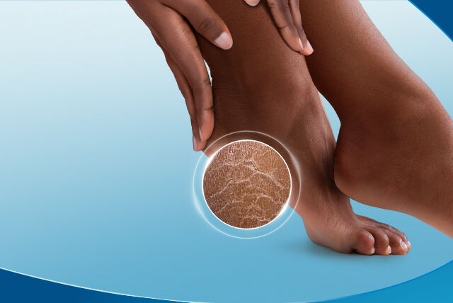 Piel áspera o Escamosa | Cetaphil®